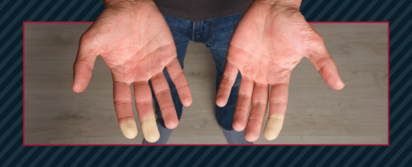 Hand Arm Vibration Syndrome – Causes and Prevention | NASP